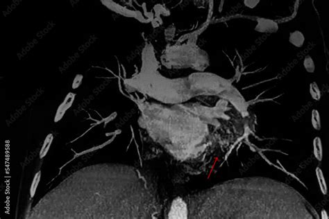 Cat Scan Image Pulmonary Angiography Showing Lung Adenocarcinoma With