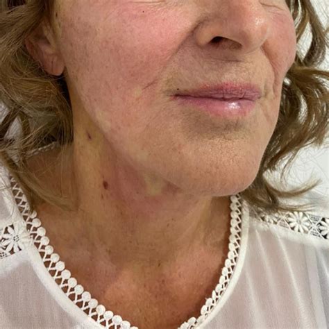 Pdo Threading Cardiff Cosmetic Clinic