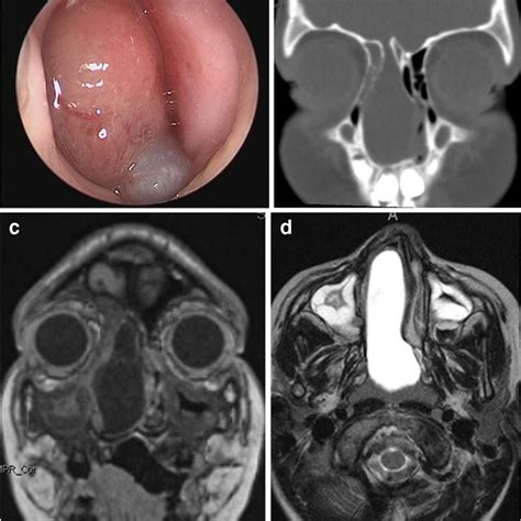 A Intraoperative View Via Rigid Nasal Endoscopy Of A Left Sided Nasal