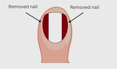 Ingrown Toenails Removal And Infected Toenails Treatment Nail Surgery