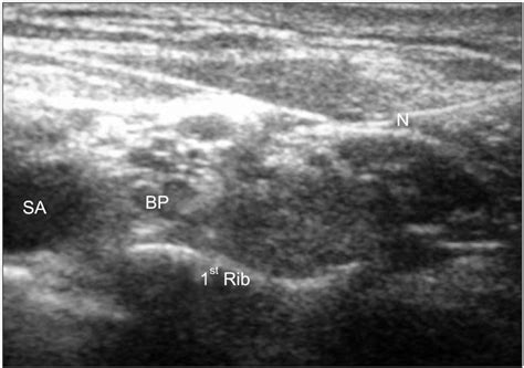 Ultrasound Image In The Supraclavicular Block Sa Subclavian Artery Download Scientific