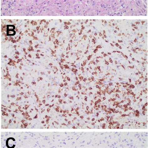 Representative Photos Of The Patients Excisional Biopsy Of A Left