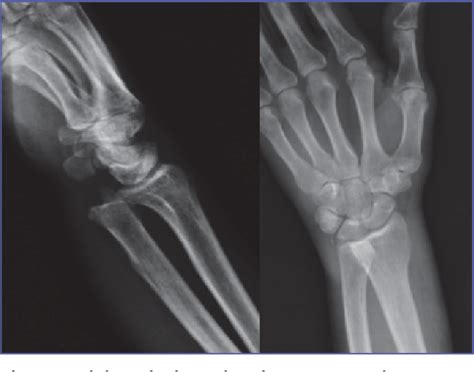 Figure 1 From Isolated Volar Ulnar Dislocation Case Report And Literature Review Semantic Scholar