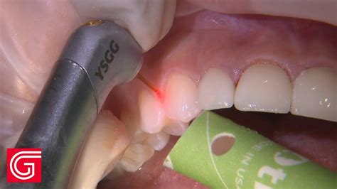Ada Code For Laser Gingivectomy At Donna Willey Blog