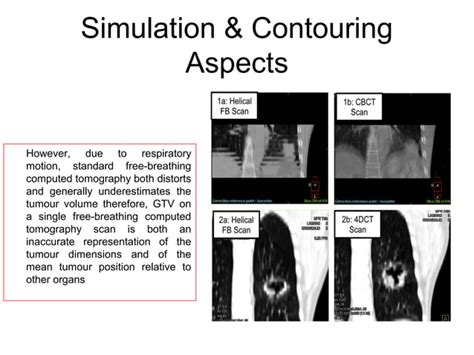 Sbrt Contouring Guidelines Ppt
