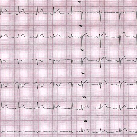 The 12 Lead Electrocardiogram Showing Diffuse ST Segment Elevation In