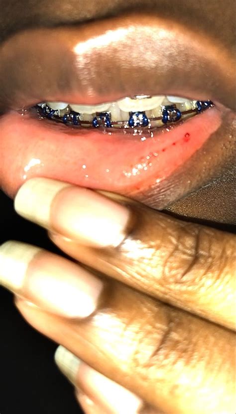 Braces 😔 Teal Braces Aesthetic Braces Colors Dark Skin Teal Braces