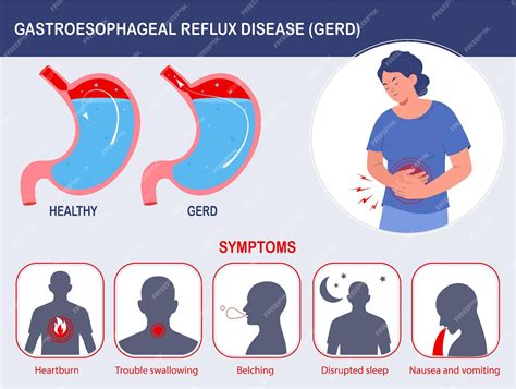 Premium Vector Gastroesophageal Reflux Disease Gerd Infographic Gerd