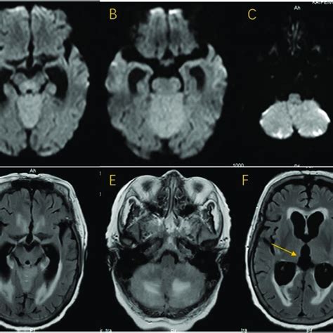 A B C D E The Size Of Lesions Did Not Change Too Much Compared To