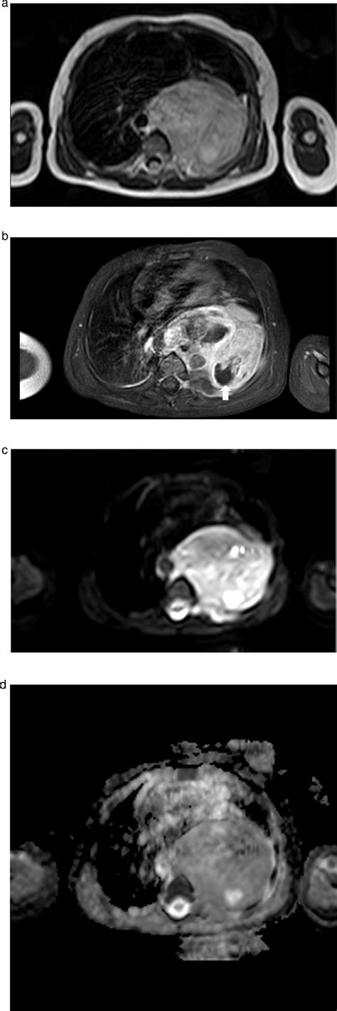 Chest Magnetic Resonance Imaging Mri A Axial T2 Weighted Spin Echo