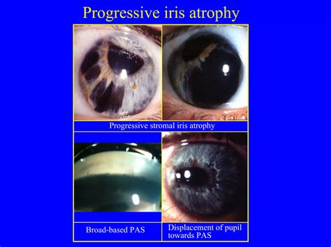 Diplopia Strabismus Ppt Talk10 2010 Ppt