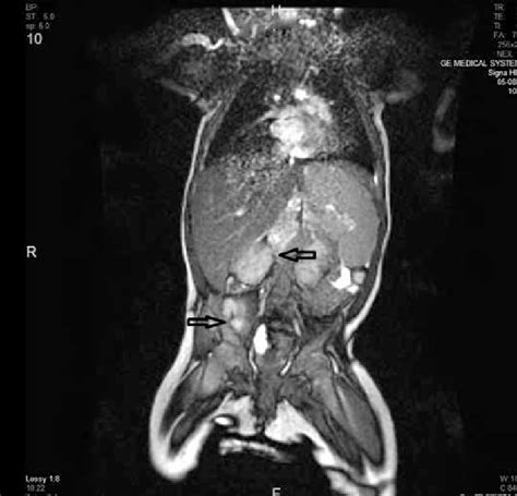 Abdominal Magnetic Resonance Imaging Mri With Solid Mass Behind The