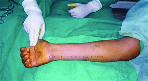The Planned Incision From Pisiform To Proximal Forearm Ulno Volar