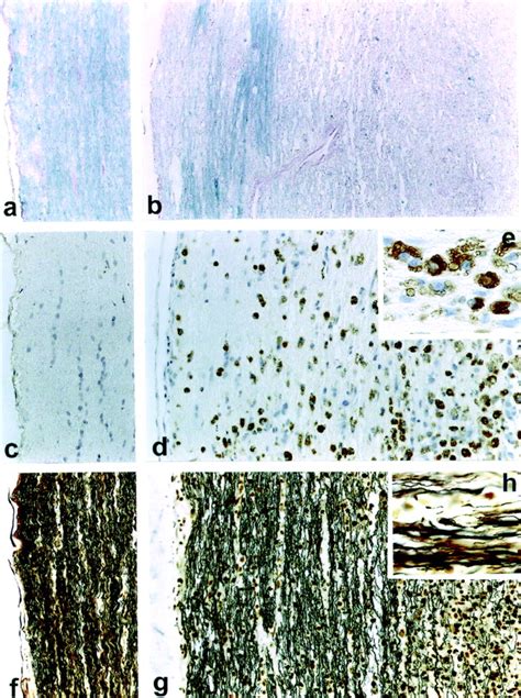 Acute Neuronal Apoptosis In A Rat Model Of Multiple Sclerosis Journal