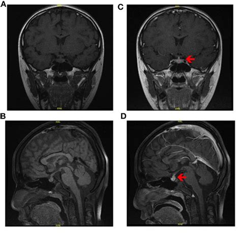 Mri Characteristics Of Rosai Dorfman Disease Involving Sellar Region