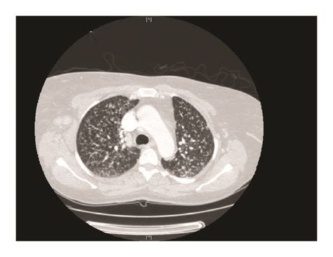 Ct Scan Of The Chest Showing Miliary Pulmonary Nodules Download
