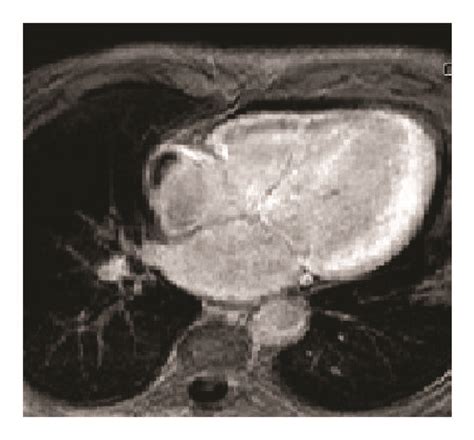 Cmr Short Axis A And Four Chamber View B Lge Images Showing Download Scientific Diagram