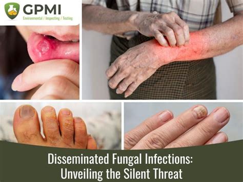 Fungalinfections Healthawareness Disseminatedfungalinfections