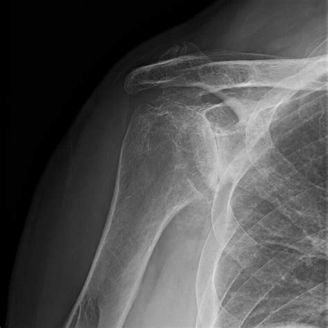 Dr Mcclintocks Shoulder X Ray Image Gallery Kyle Mcclintock Do Orthopedic Surgeon
