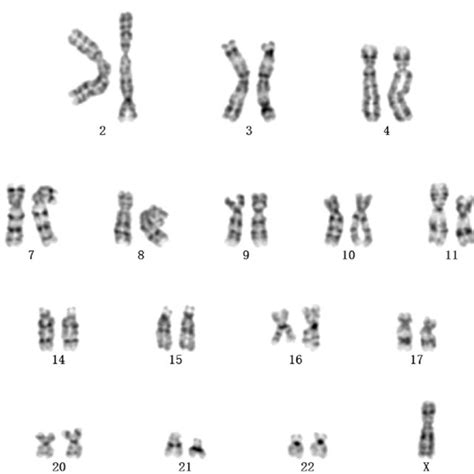 Snp Array Analysis Showing That The Paternal Chromosomes Were Normal