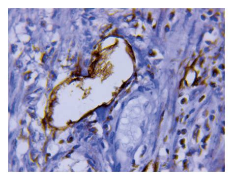 Atypical Dilated Capillaries A Atypical Dilated Capillary In The