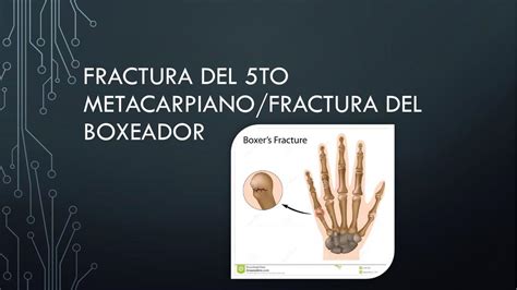 Fractura Del 5to Metacarpiano Dejesus Muñoz Udocz