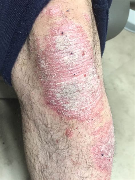 劉醫師專欄 乾癬的須知與治療 下 • 哇靠紐約 Wacowny 吃貨美食 旅游 電影 活動 找工作 購物 美妝 哇靠紐約 Wacowny 吃貨美食 旅游