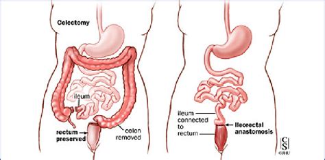 A Resection Of The Cecum And Ileum B Ileorectal Anastomosis