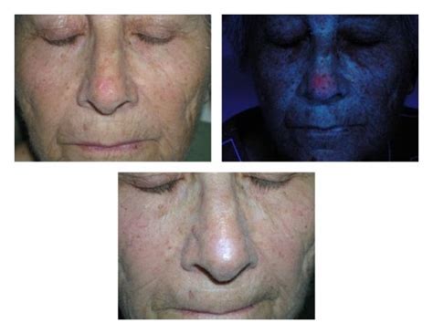 Superficial Bcc In The Nose Inexact Fluorescence And Complete Response