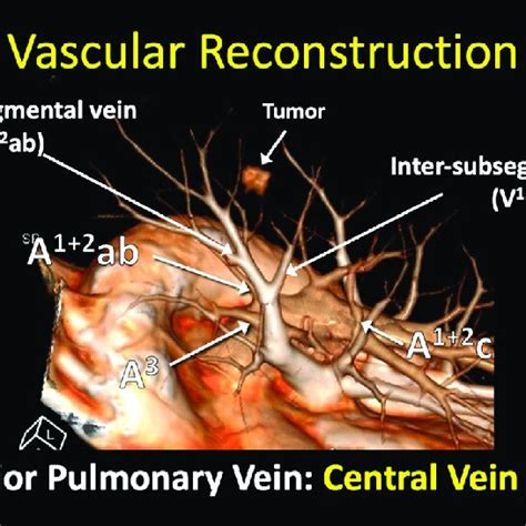 Vascular Reconstruction Of The Left Pulmonary Artery And Vein Using Download Scientific Diagram