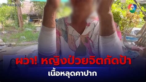 ข่าวผวา หญิงป่วยจิตคลุ้มคลั่ง กัดป้าอายุ 56 ปี เนื้อหลุดคาปาก