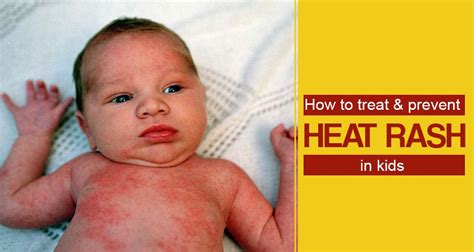 How To Treat Itchy Heat Rash Heat Rash Prickly Heat Causes