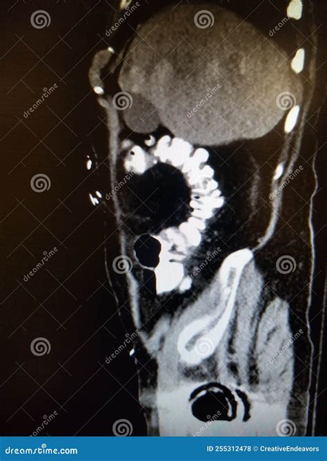 Abdomen Ct With Question Mark Shaped Colon Royalty Free Stock Image