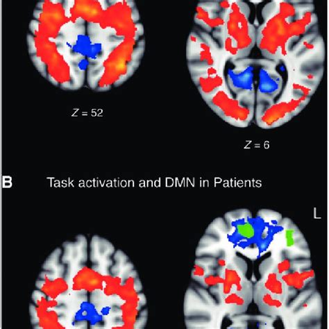 Task Induced Activation Differences Within The Default Mode Network Download Scientific Diagram