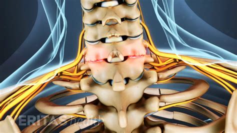 Osteophyte Formation In Cervical Spinesymptomstreatment