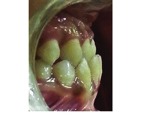 Pretreatment Intraoral Profile View Photograph Depicting Class Iii