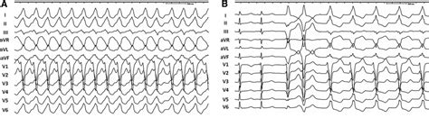 Conundrum Of Sudden Cardiac Death Circulation Arrhythmia And