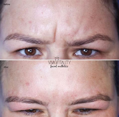 How Does Botox Work Viva Vitality Medspa