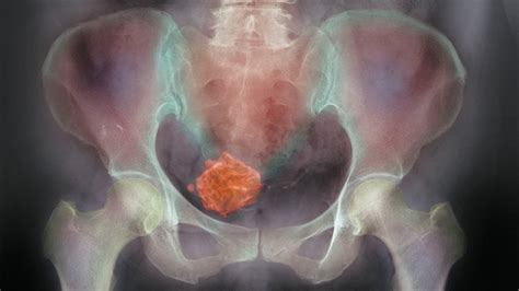 Health Problems That May Be Treated With Hysterectomy Everyday Health