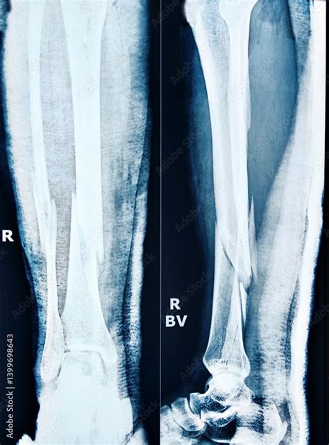This Is A Plane X Ray Of Right Leg Antero Posterior And Lateral View Showing Fracture In The