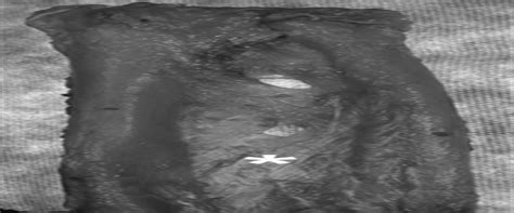 Interosseous Membrane Reconstruction For Forearm Longitudina