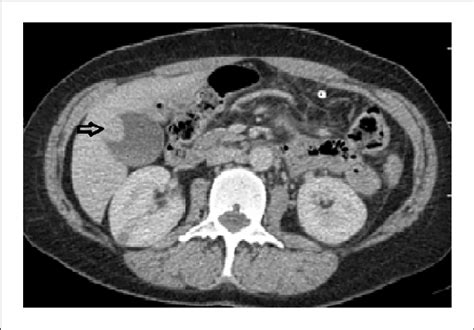 Ct Scan Metastasis In Gallbladder Download Scientific Diagram