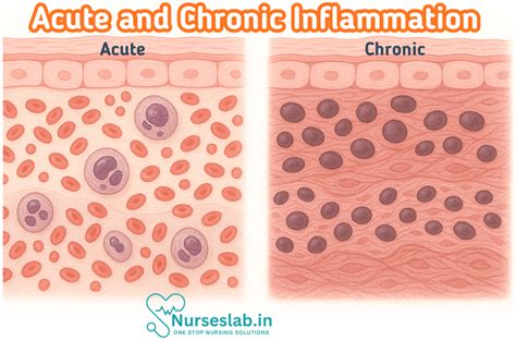 Acute And Chronic Inflammation Nurseslab