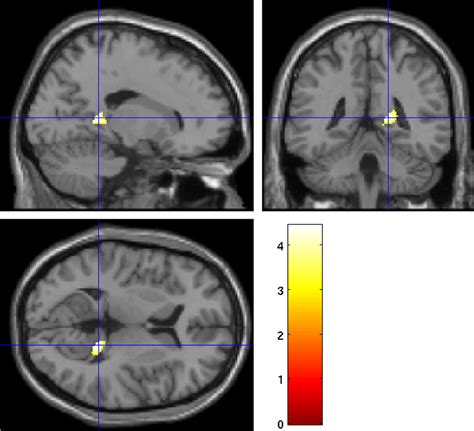 A Positive Correlation With Serum Levels Of Apolipoprotein A I And