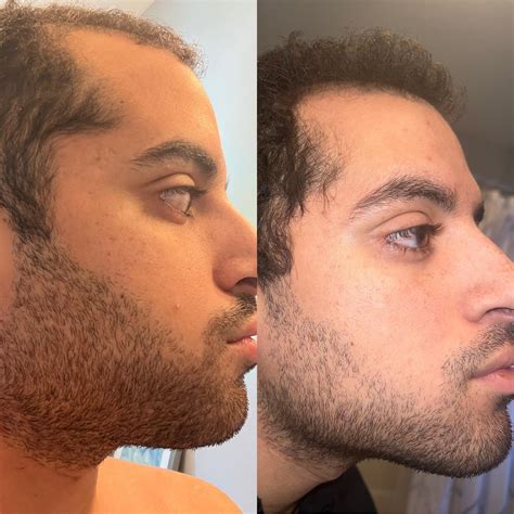Can Hrt Make Laser Hair Removal Less Effective Rmtf