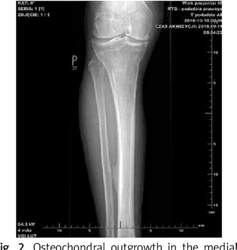 Figure 1 From Rheumatoid Neutrophilic Dermatitis Semantic Scholar