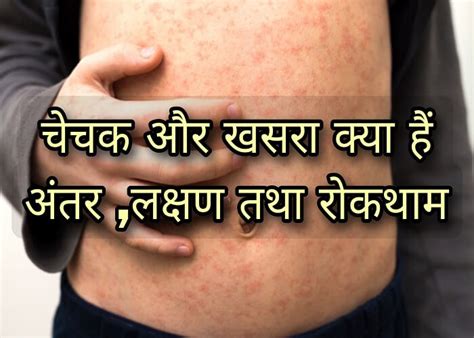 चेचक और खसरा क्या हैं इनके बीच अंतर लक्षण प्रसार उपचार और रोकथाम