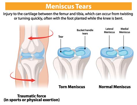 Knee Meniscus And Acl Surgery What You Need To Know Aosmi