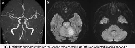 Figure 1 From Novel Use Of A Closed Tip Stent Retriever To Prevent Distal Embolism In The