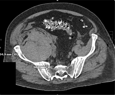 Spontaneous Retroperitoneal Hematoma After Total Hip Arthroplasty R